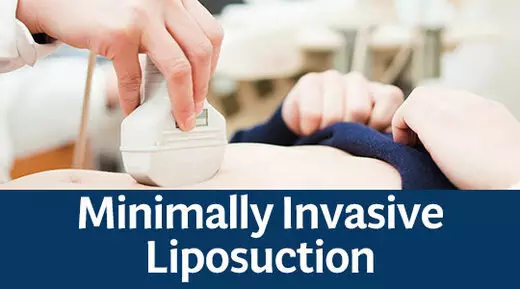 Lehilahy mahazo liposuction kely indrindra invasive amin'ny ultrasound