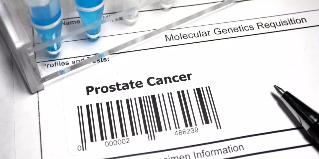 Iwadi Iṣoogun Tuntun Ṣafihan Ọna asopọ pataki Laarin Iṣẹ iṣe ti ara ati Akàn Prostate